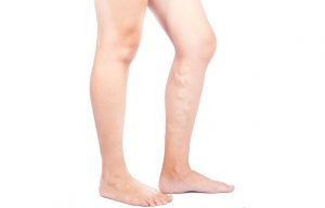 O que é flebite e como tratar? - Dr. Bruno Carvalho Angiologia e Cirurgião